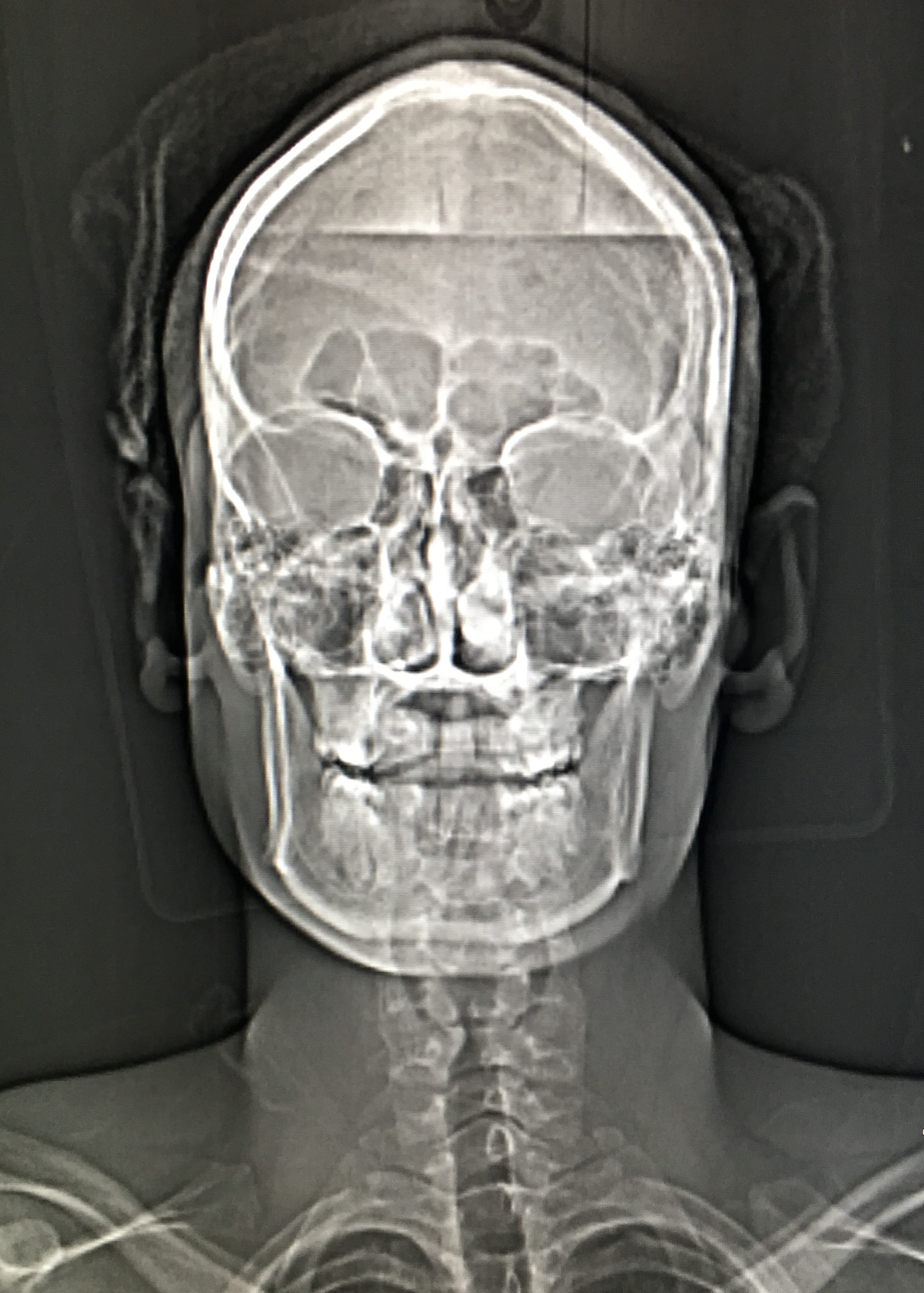 “Slack-Jaw Boogaloo” – Great Exudations