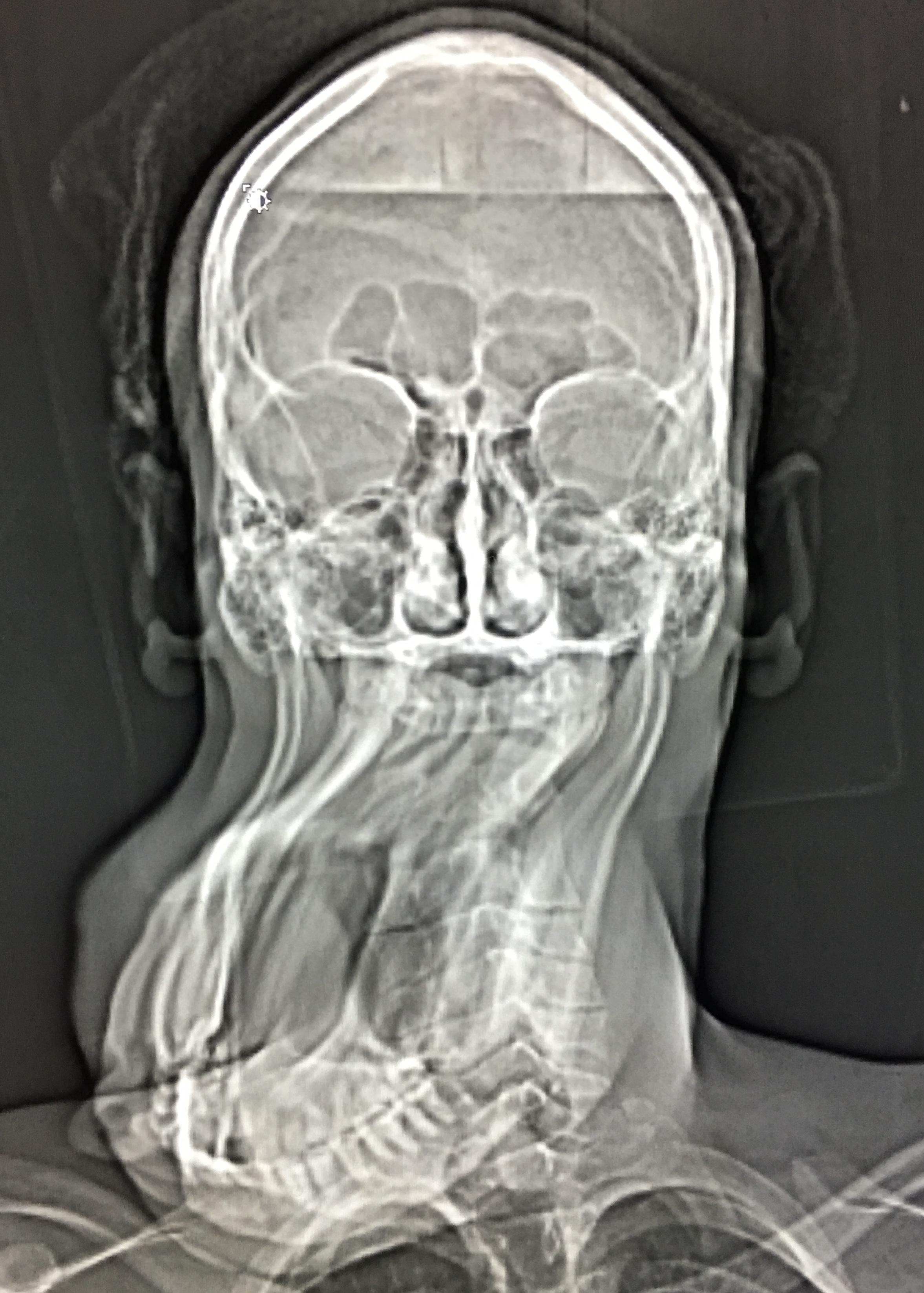 “Slack-Jaw Boogaloo” – Great Exudations