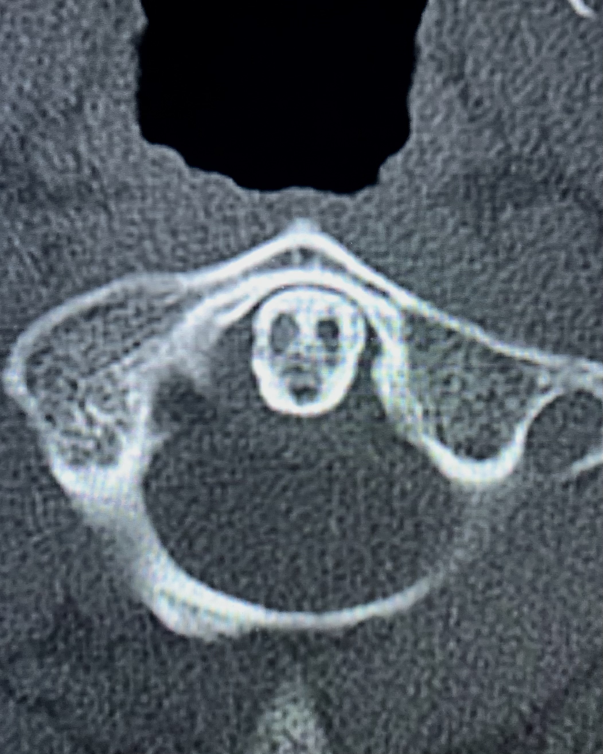 “Phantom Odontoideum” – Great Exudations