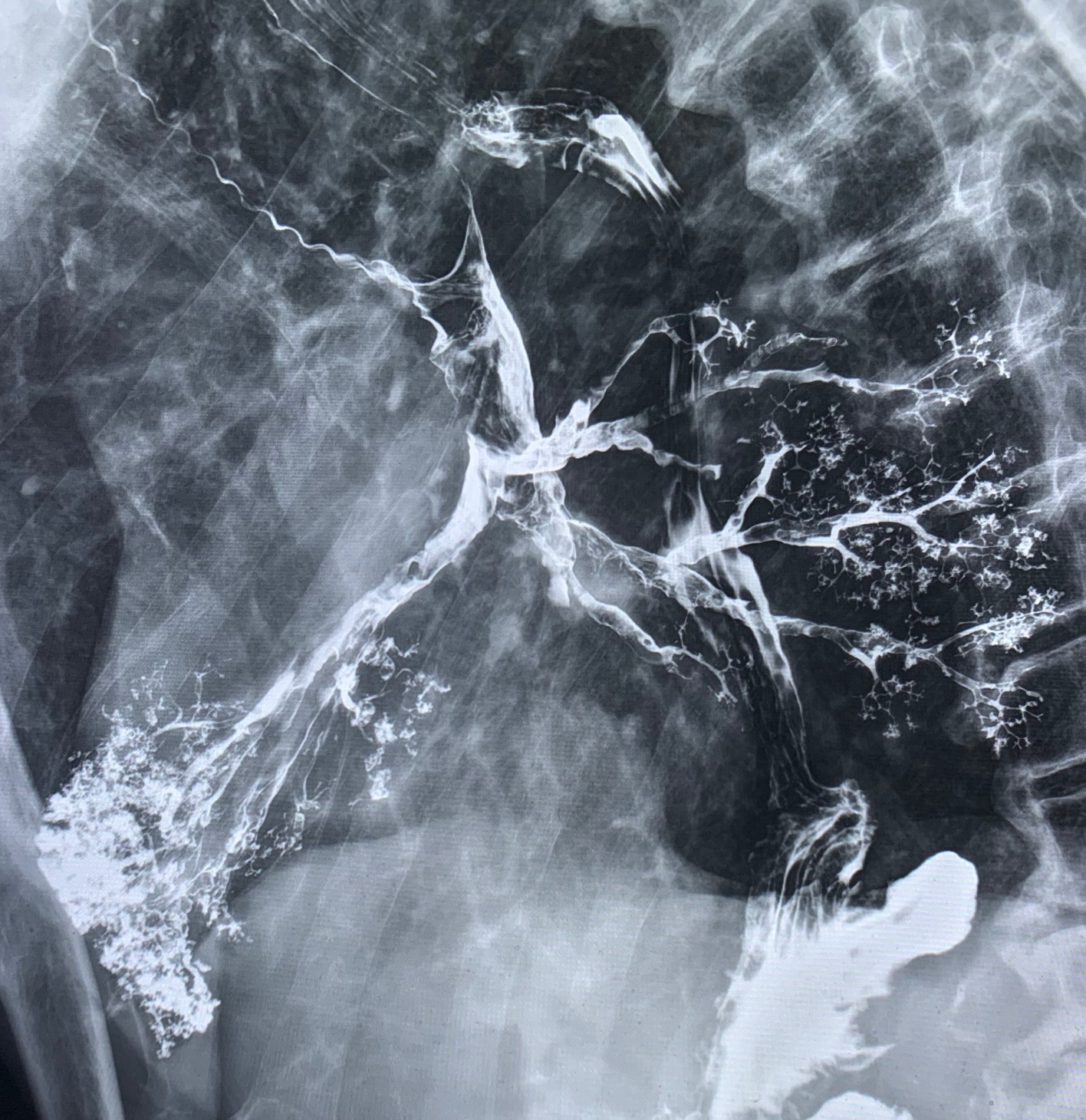 “Endobronchial Broccolini” – Great Exudations